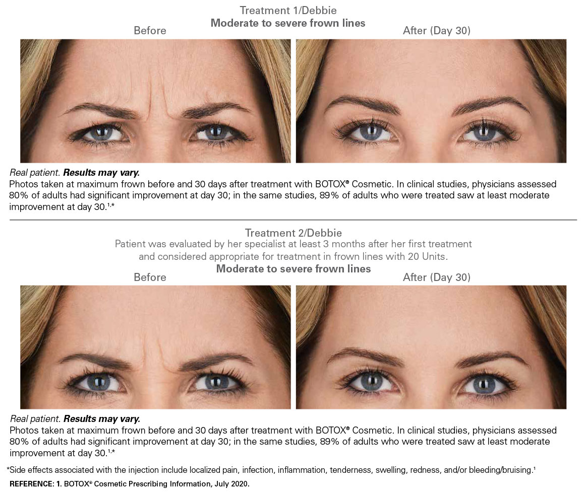 BOTOX® – The Perfect Image MedSpa
