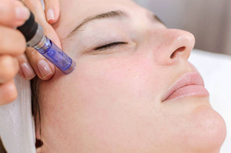MICRONEEDLING/PRF – The Perfect Image MedSpa